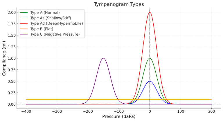 How to read Tympanogram December 2025