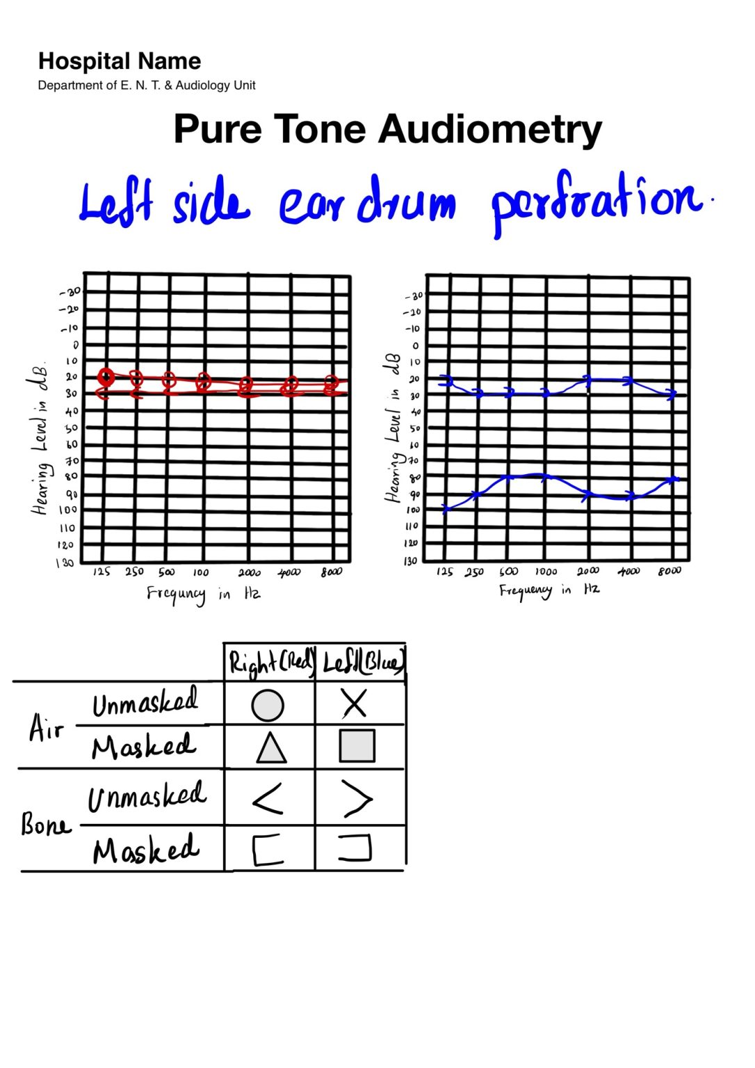 How to read Pure Tone Audiometry December 2025